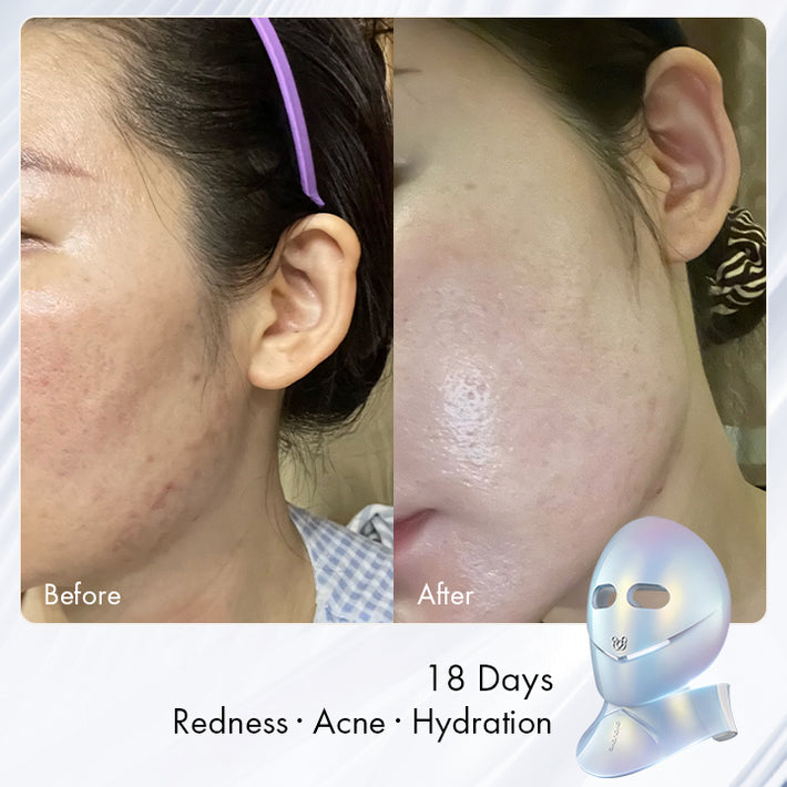 The Radiance Kit – LED Face & Neck Masks – CHOUCHOU TOKYO